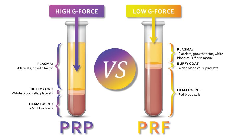 PRF vs PRP: Which Is The Right One For You